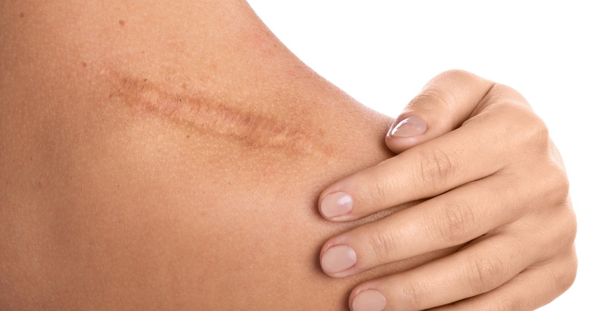 Narben im Sommer: Pflegetipps einer Expertin | Ordensklinikum Linz
